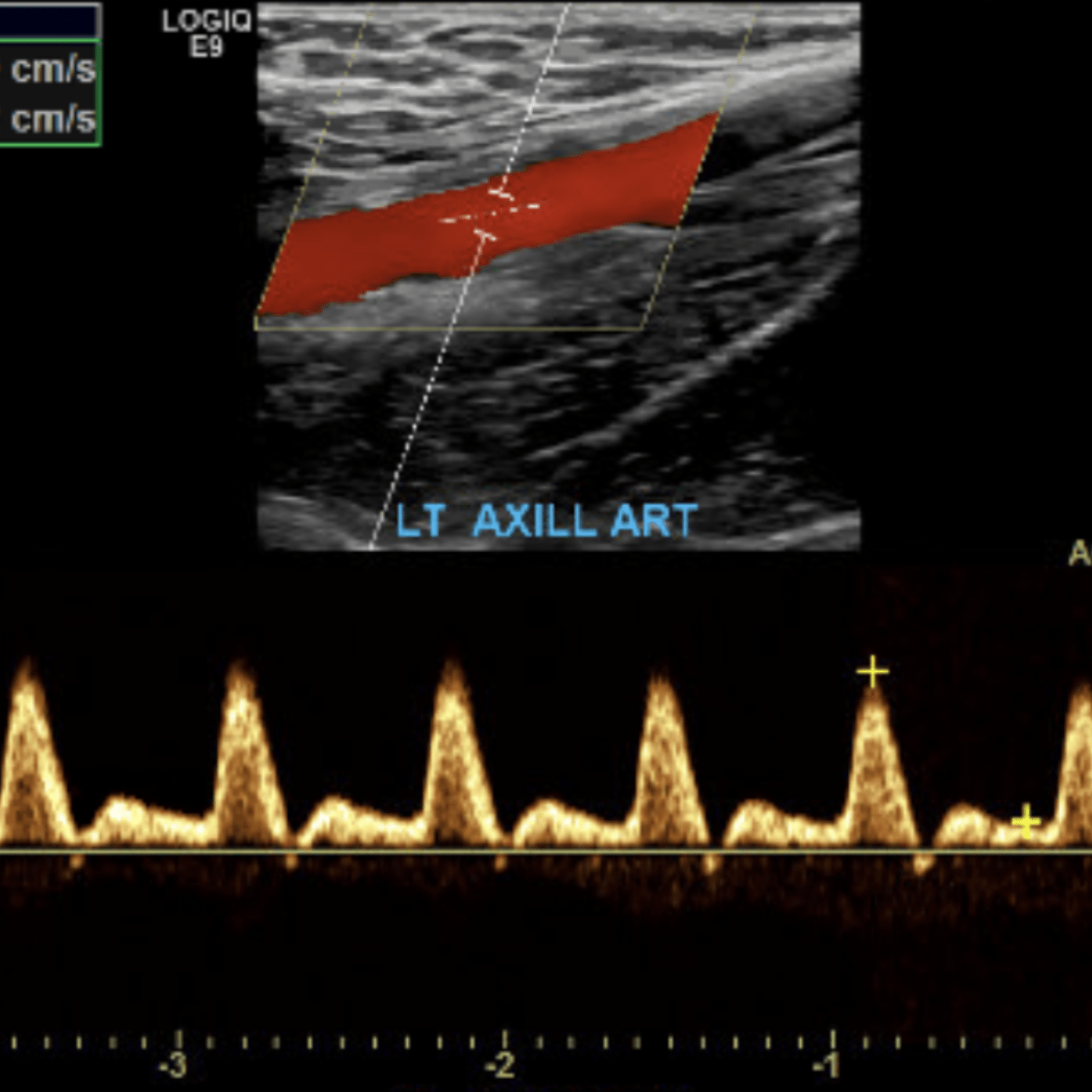 Arterial Duplex/Doppler Sonography of the Upper Extremities ...