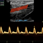Arterial Duplex/Doppler Sonography of the Upper Extremities ...