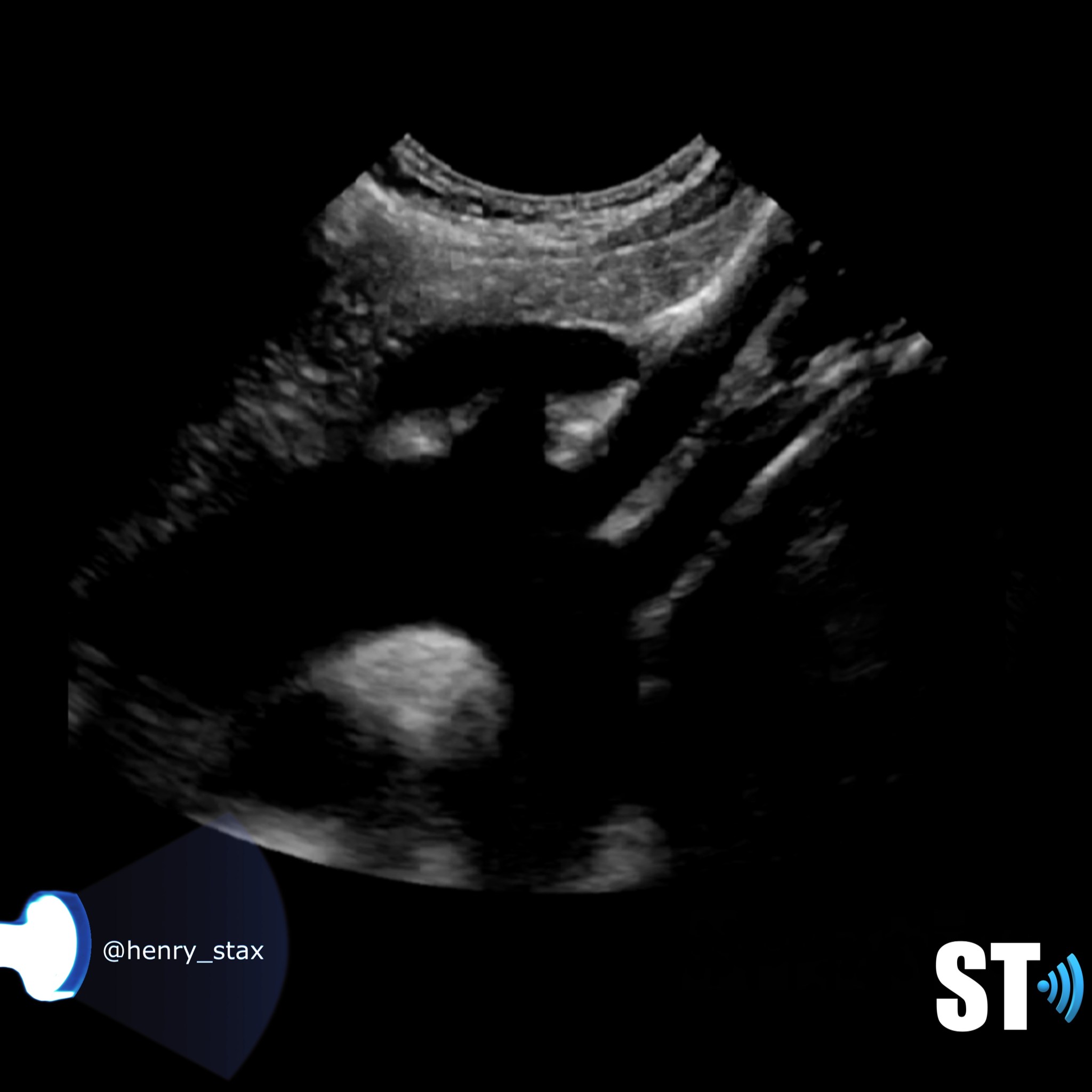 Arterial Duplex/Doppler Sonography of the Upper Extremities ...