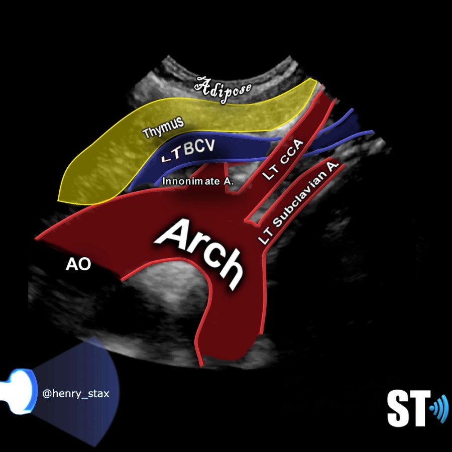 Arterial Duplex/Doppler Sonography of the Upper Extremities ...