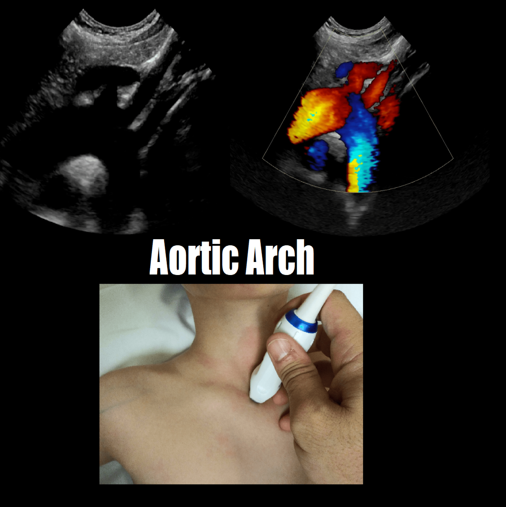 Arterial Duplex/Doppler Sonography of the Upper Extremities ...