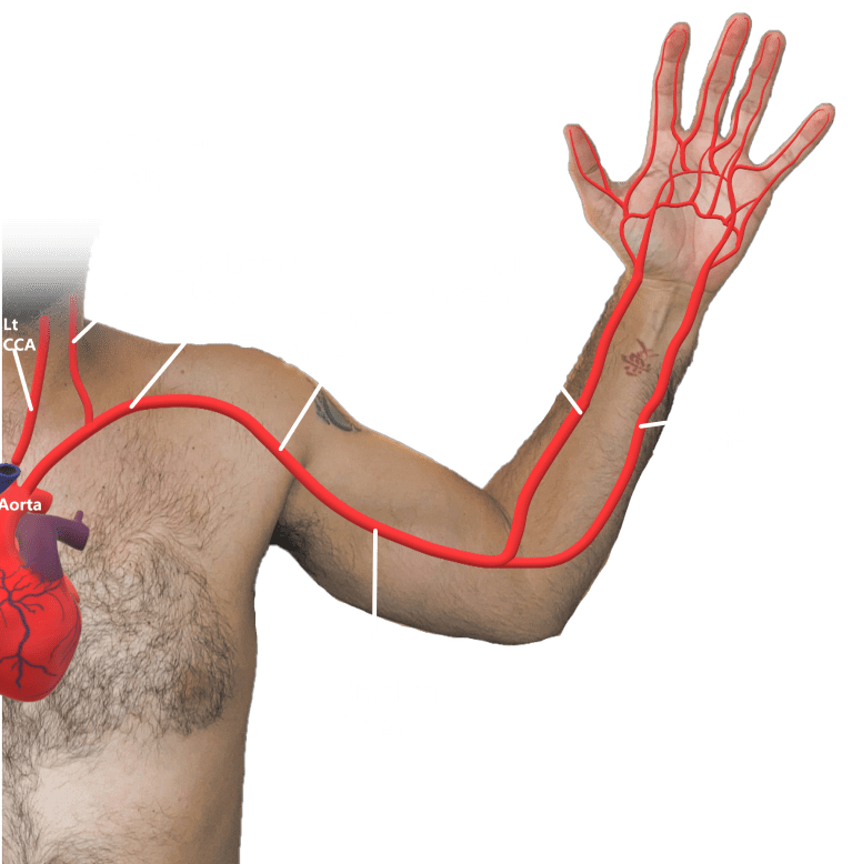 Arterial Duplex/Doppler Sonography of the Upper Extremities ...