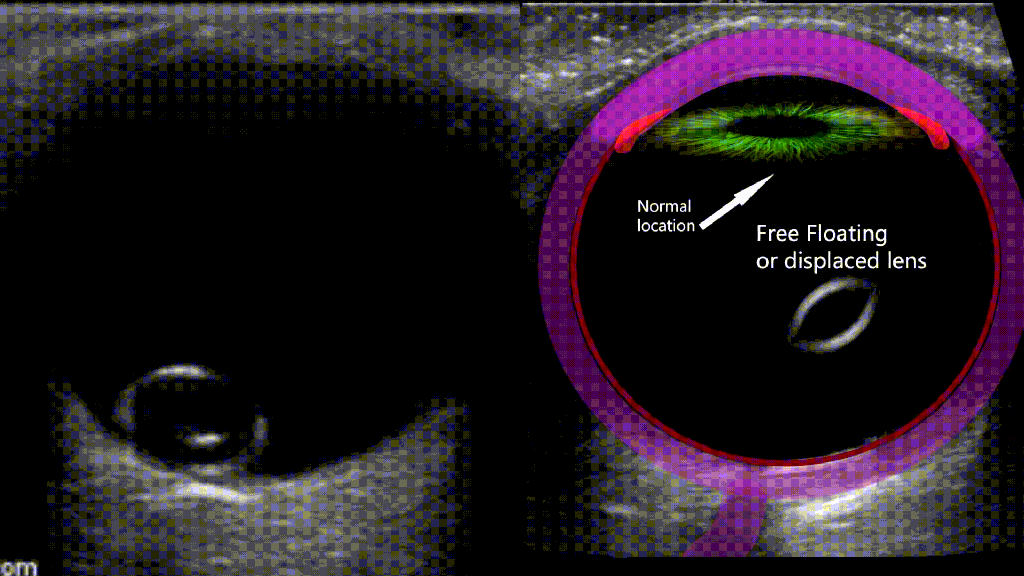Ocular Ultrasound – Sonographic Tendencies
