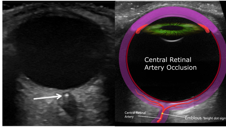 Ocular Ultrasound – Sonographic Tendencies