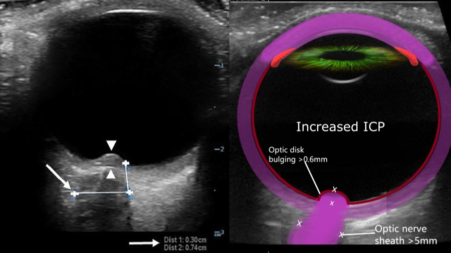 Ocular Ultrasound – Sonographic Tendencies
