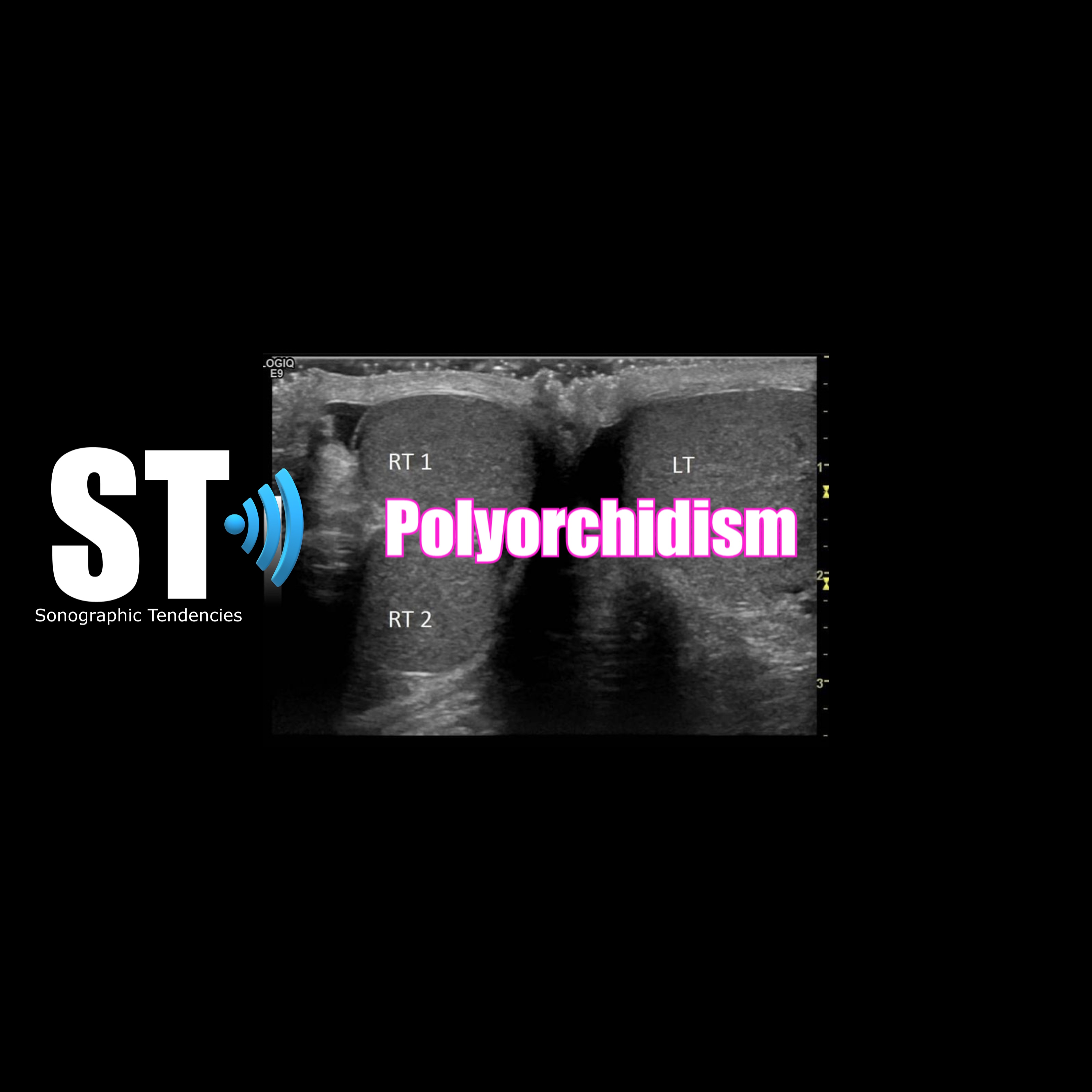 Polyorchidism – Sonographic Tendencies