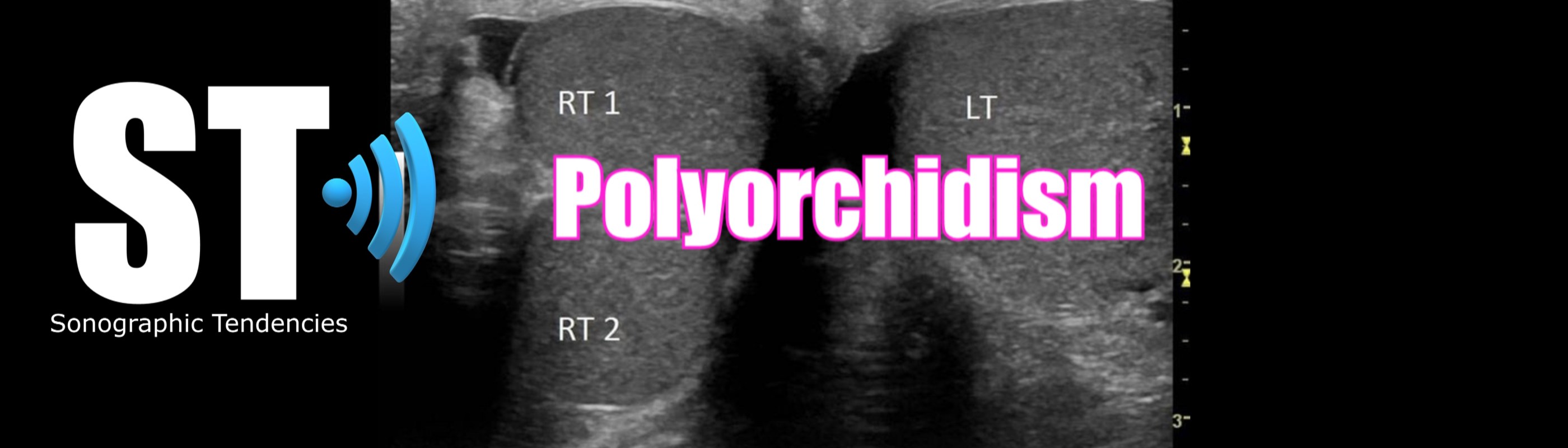 Polyorchidism – Sonographic Tendencies
