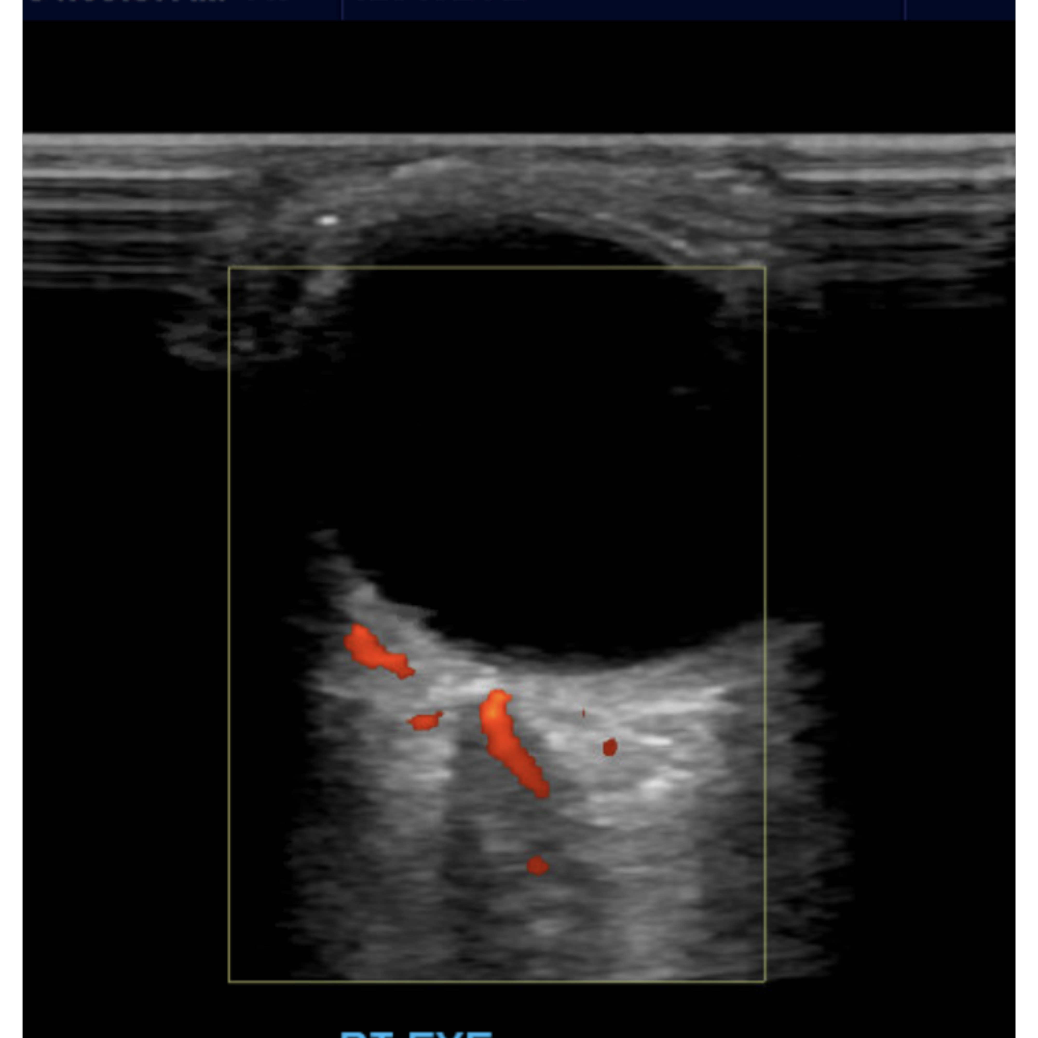 Ocular Ultrasound – Sonographic Tendencies