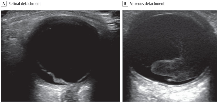 Ocular Ultrasound – Sonographic Tendencies