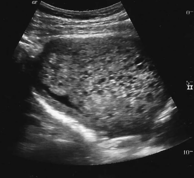 Molar Pregnancy – Sonographic Tendencies