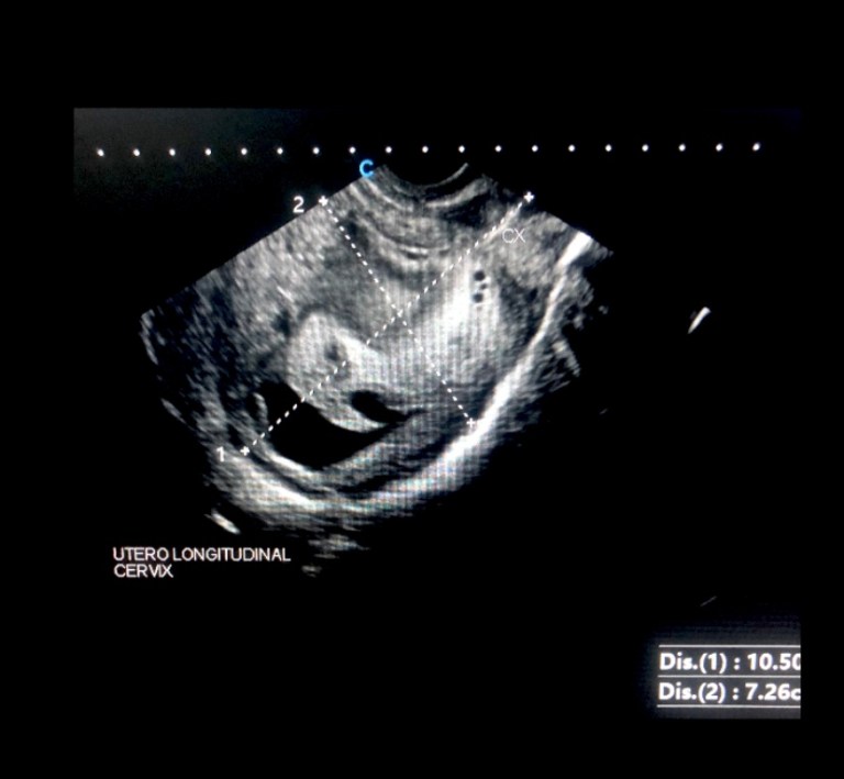Molar Pregnancy – Sonographic Tendencies
