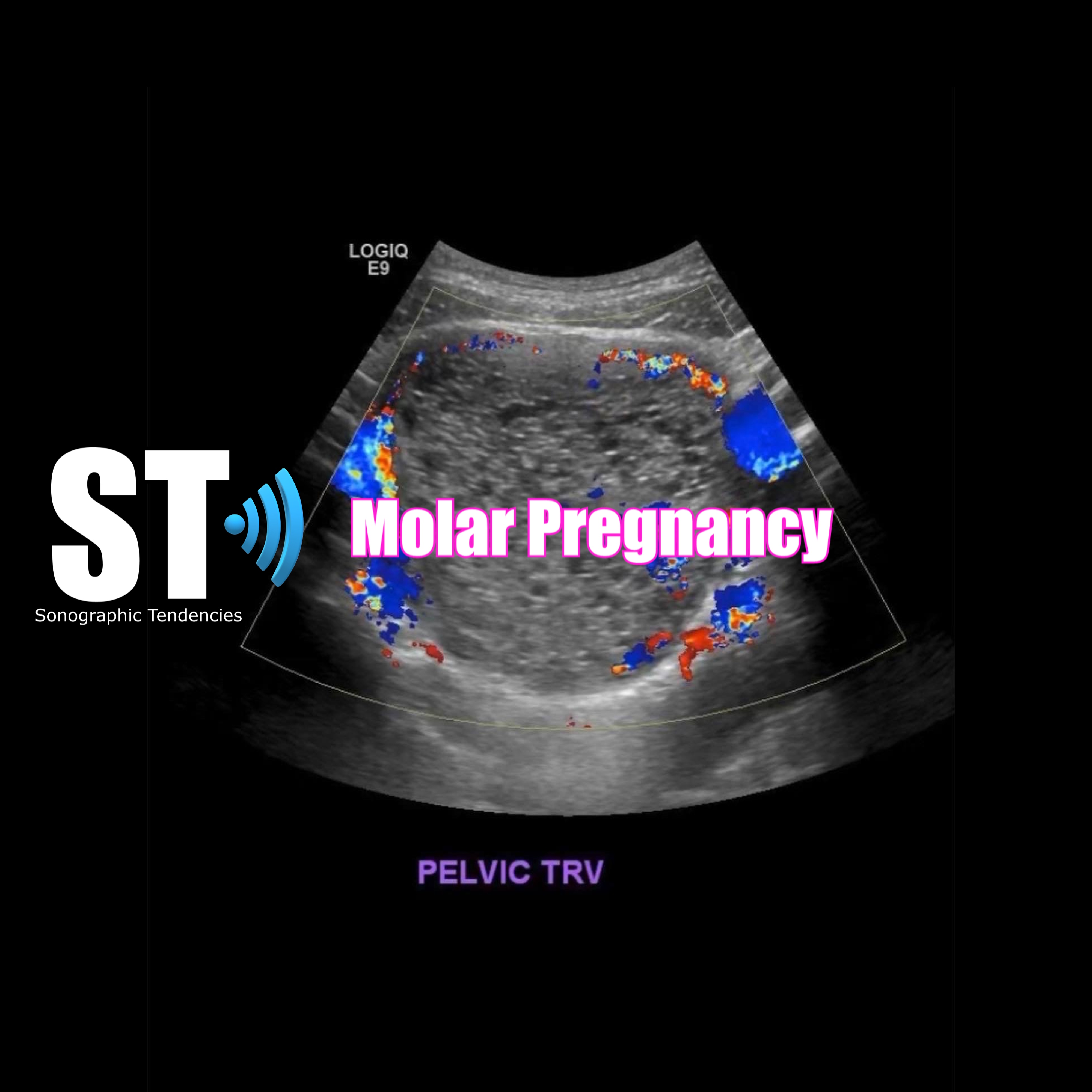 Molar Pregnancy – Sonographic Tendencies
