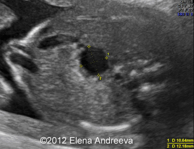 Choledochal Cyst – Sonographic Tendencies