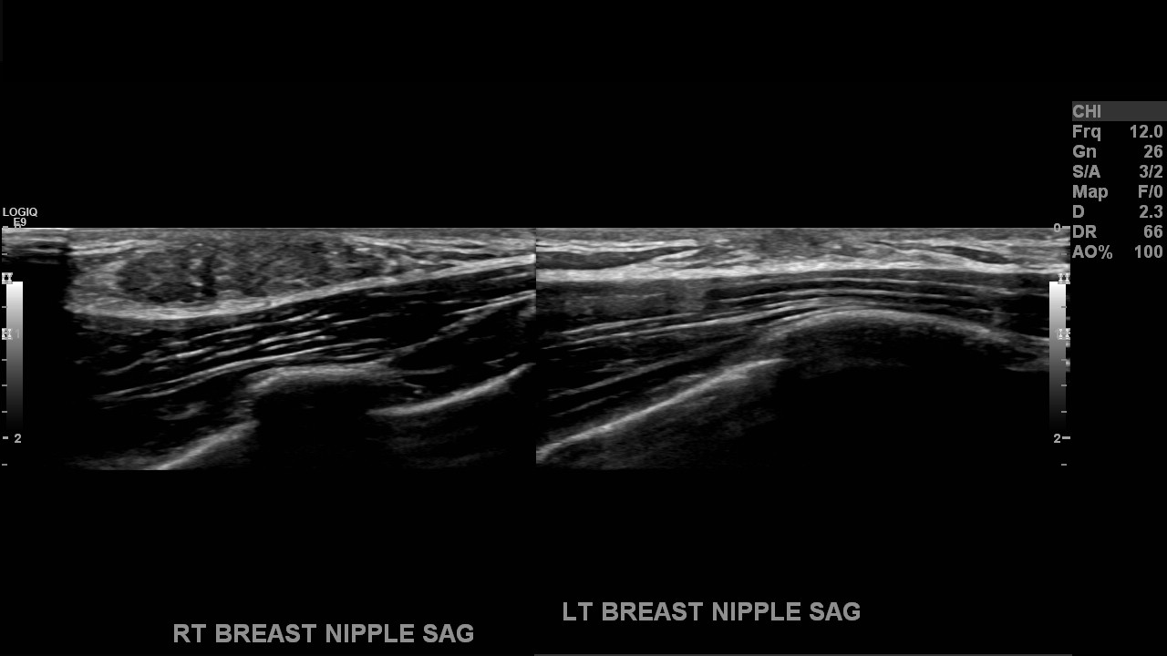 Gynecomastia – Sonographic Tendencies