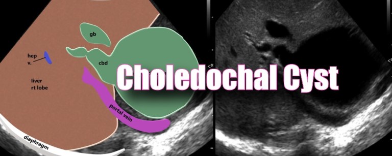 Choledochal Cyst – Sonographic Tendencies