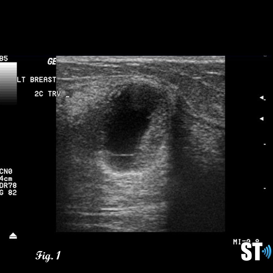 Phyllodes Tumor – Sonographic Tendencies