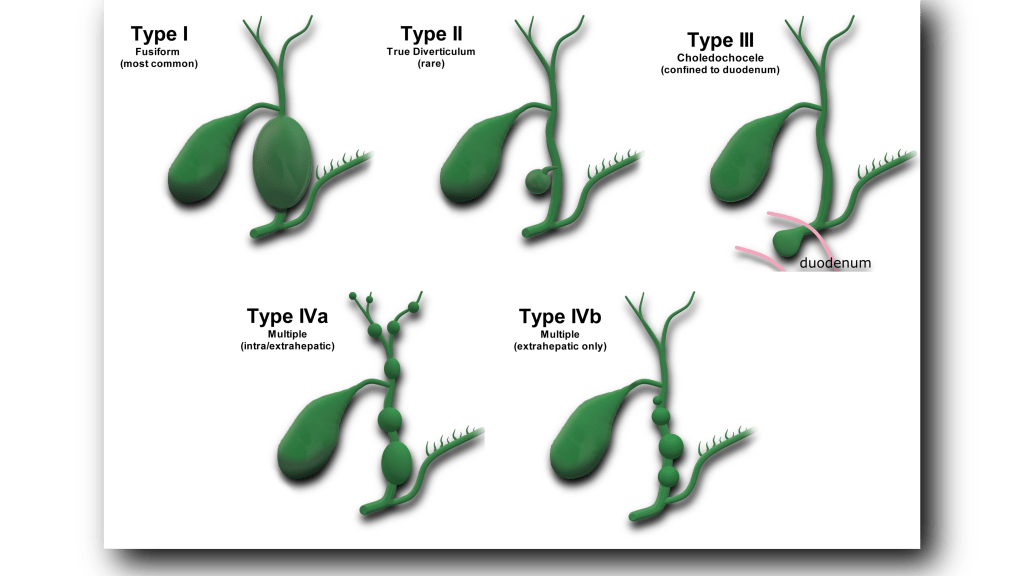 Choledochal Cyst – Sonographic Tendencies