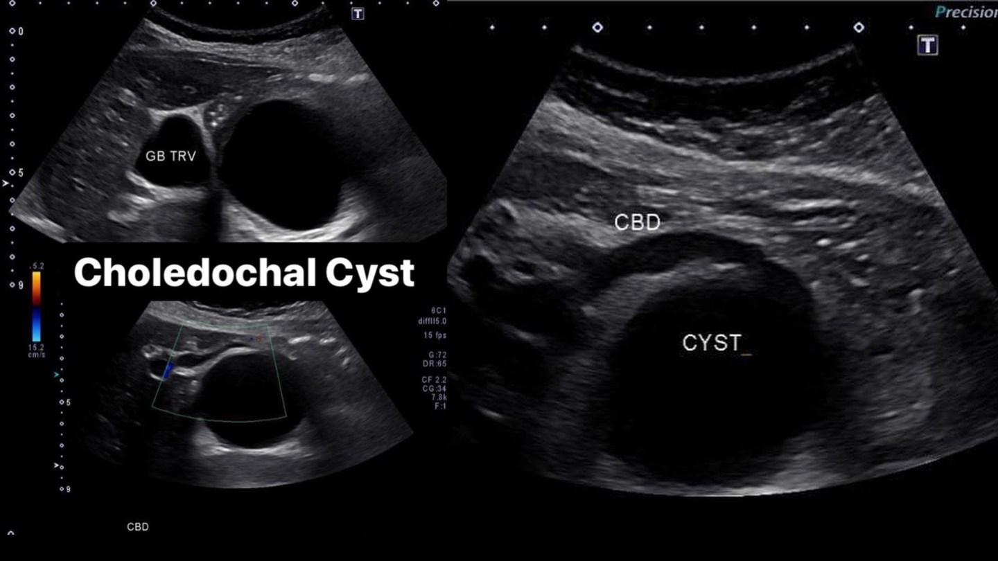 Choledochal Cyst – Sonographic Tendencies