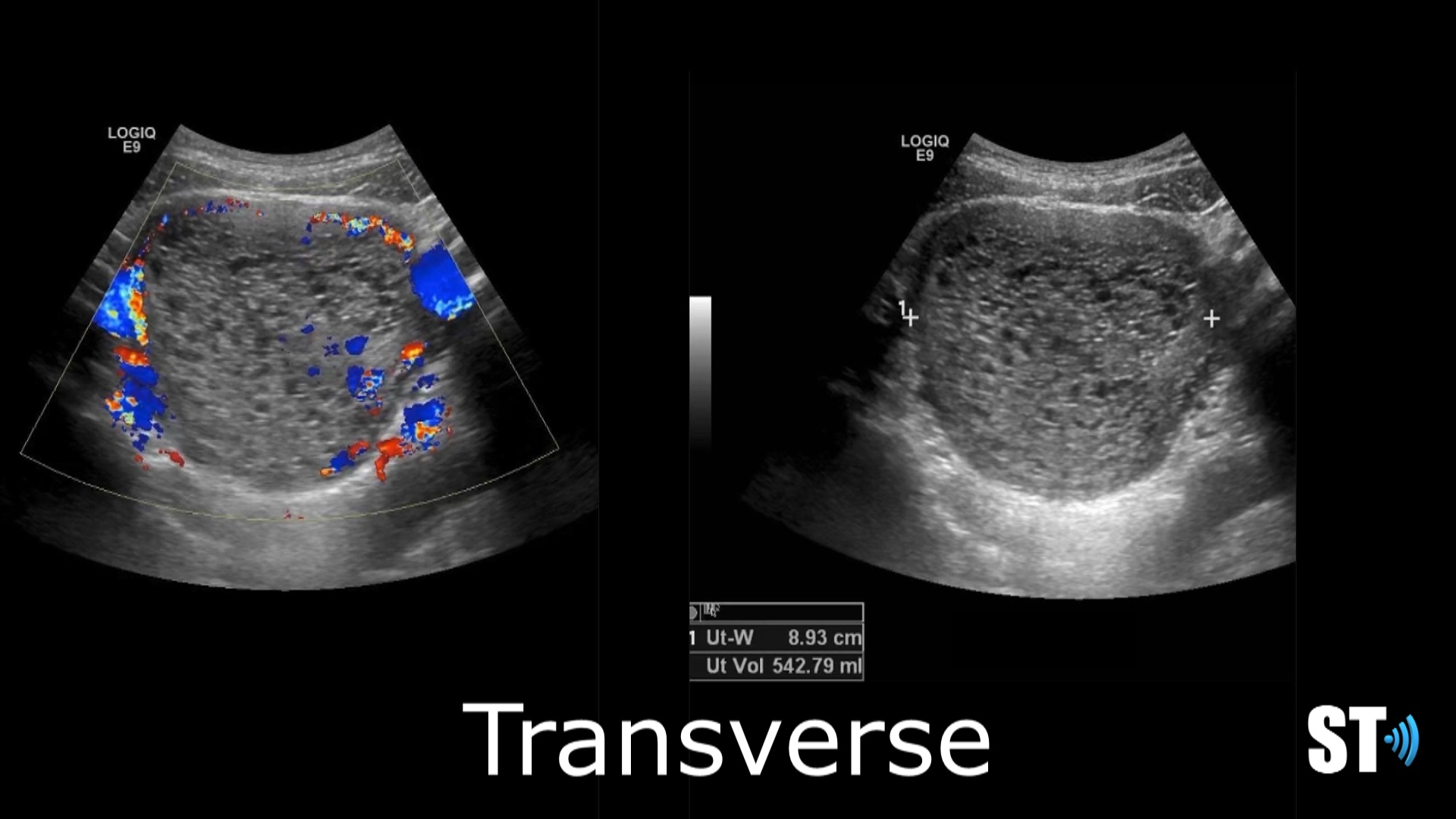 Molar Pregnancy – Sonographic Tendencies