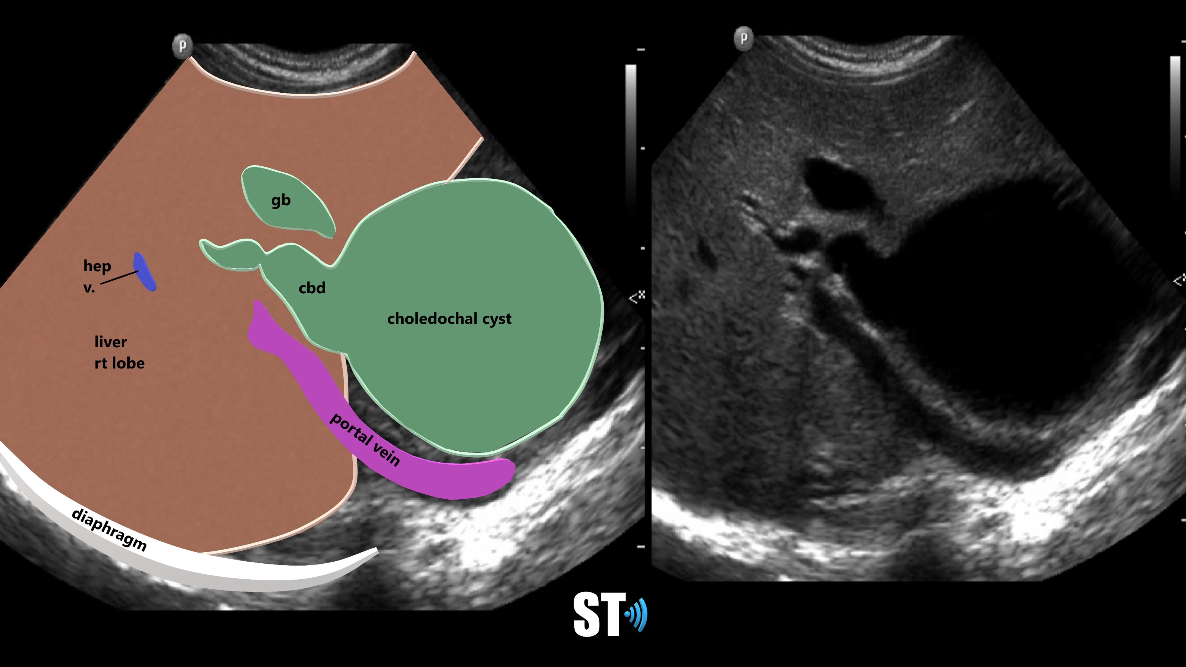 Choledochal Cyst – Sonographic Tendencies