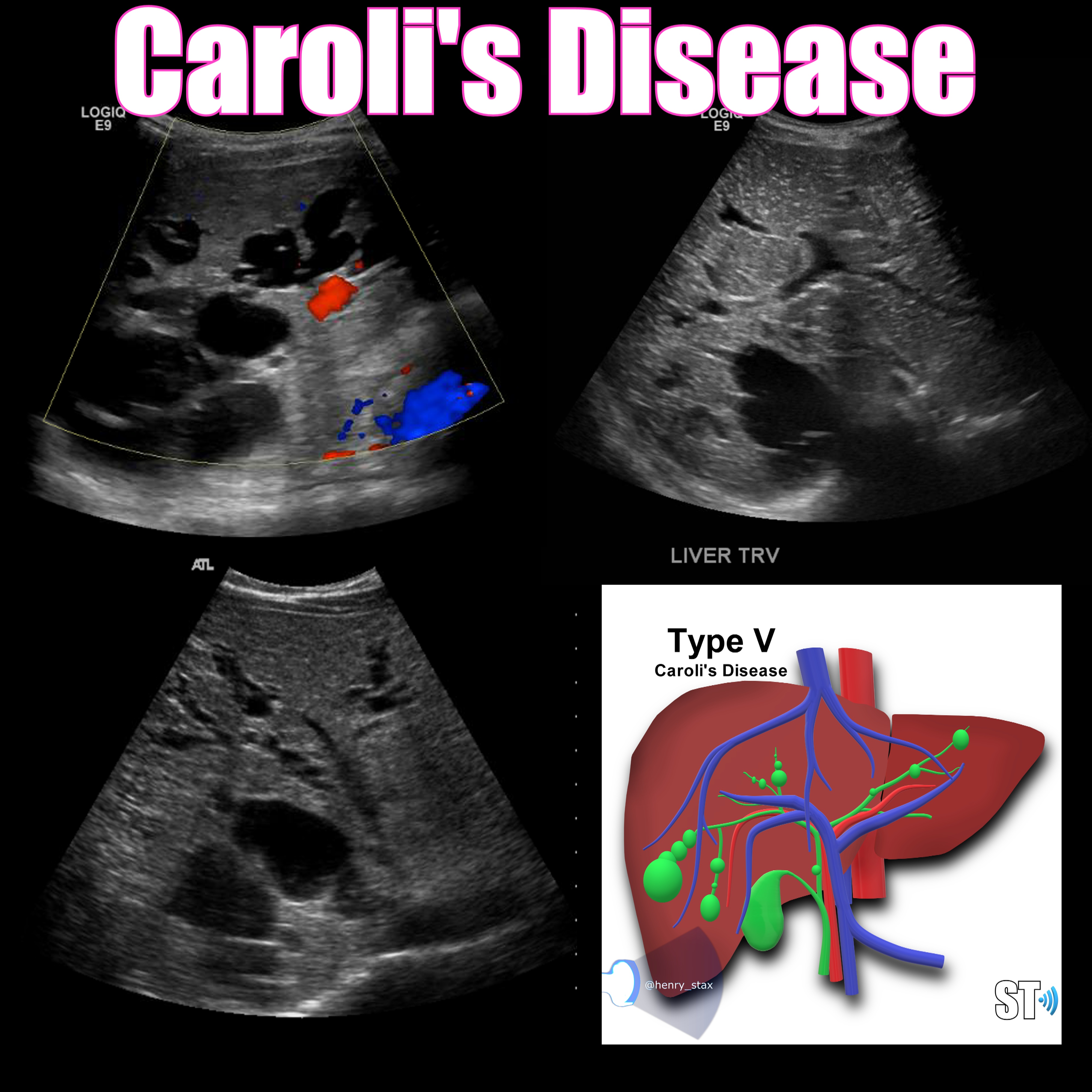 Choledochal Cyst – Sonographic Tendencies