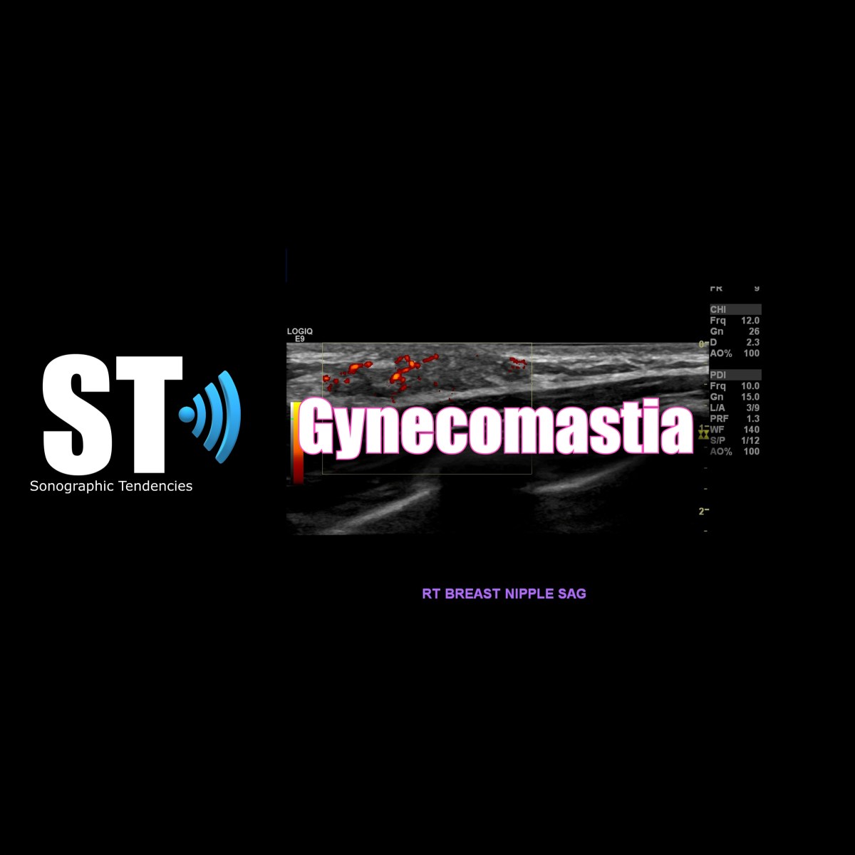 Gynecomastia – Sonographic Tendencies