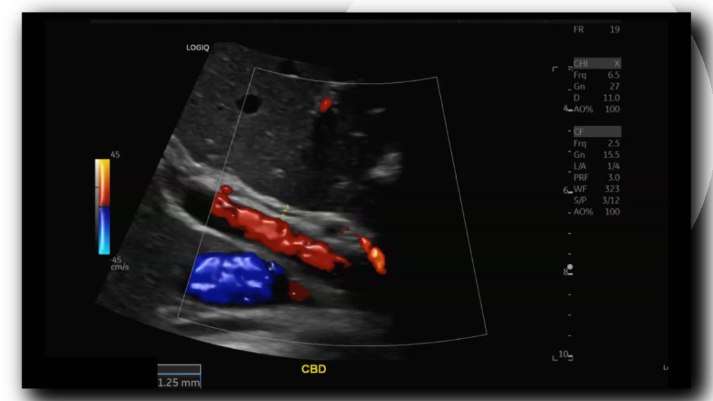 Choledochal Cyst – Sonographic Tendencies