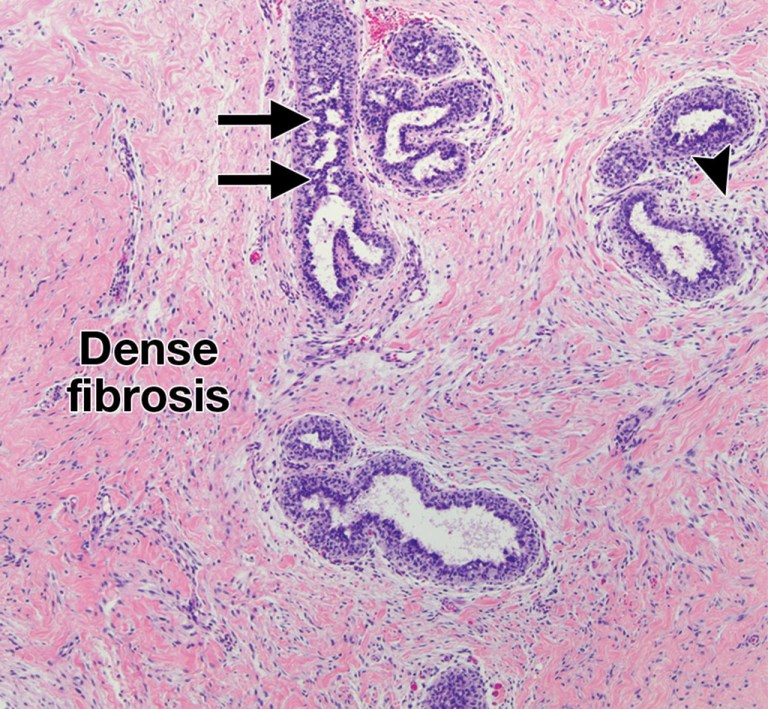 Gynecomastia – Sonographic Tendencies