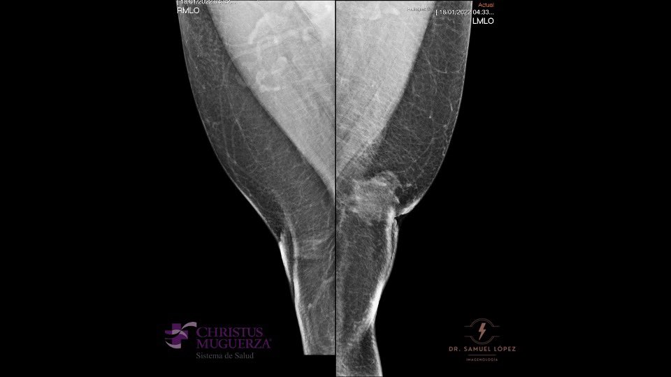 Gynecomastia – Sonographic Tendencies