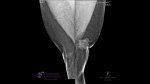 Gynecomastia – Sonographic Tendencies