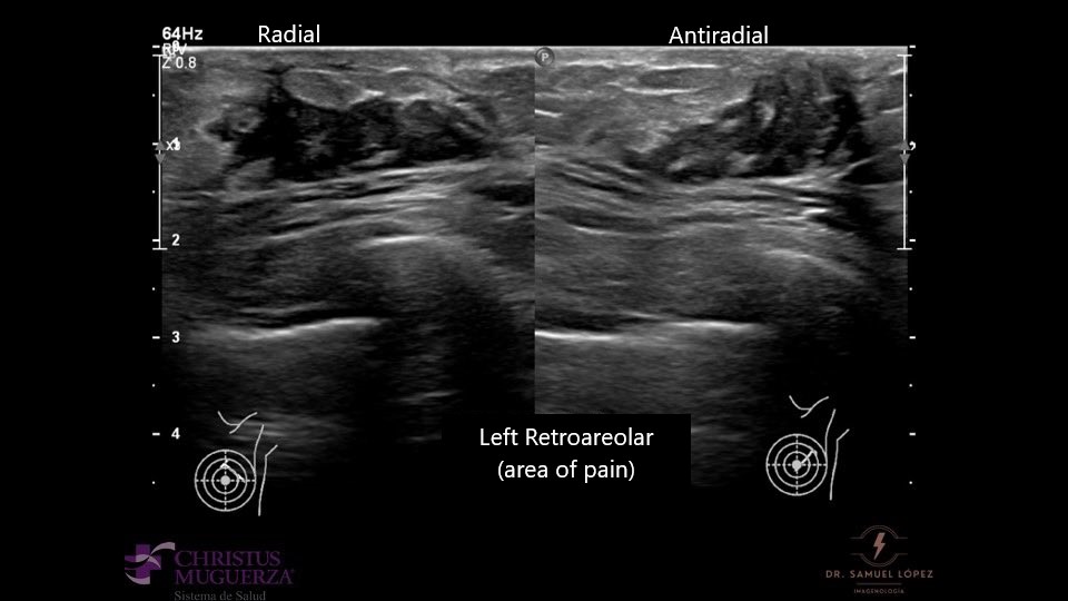 Gynecomastia – Sonographic Tendencies