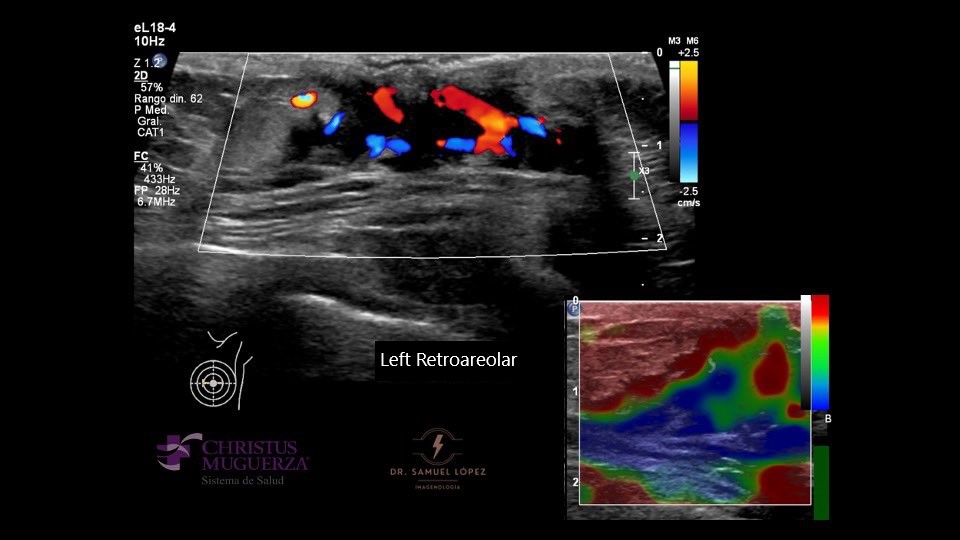 Gynecomastia – Sonographic Tendencies