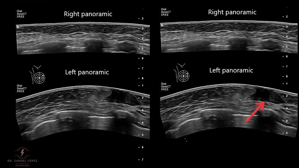 Gynecomastia – Sonographic Tendencies