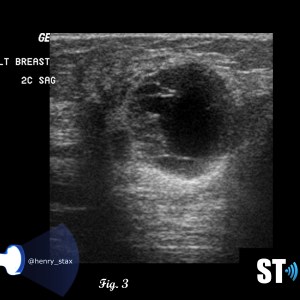 Phyllodes Tumor – Sonographic Tendencies