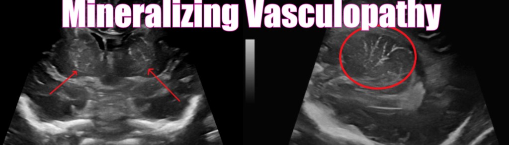 Mineralizing Lenticulostriate Vasculopathy – Sonographic Tendencies