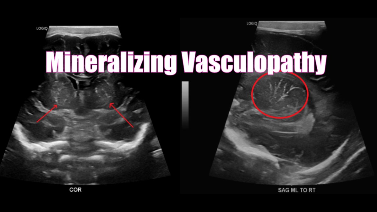 Mineralizing Lenticulostriate Vasculopathy – Sonographic Tendencies