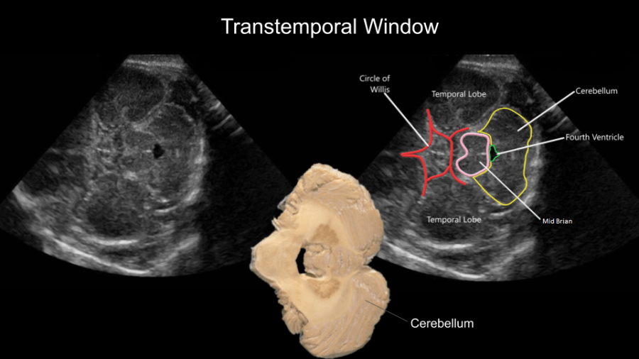 Neonatal Neurosonography – Sonographic Tendencies