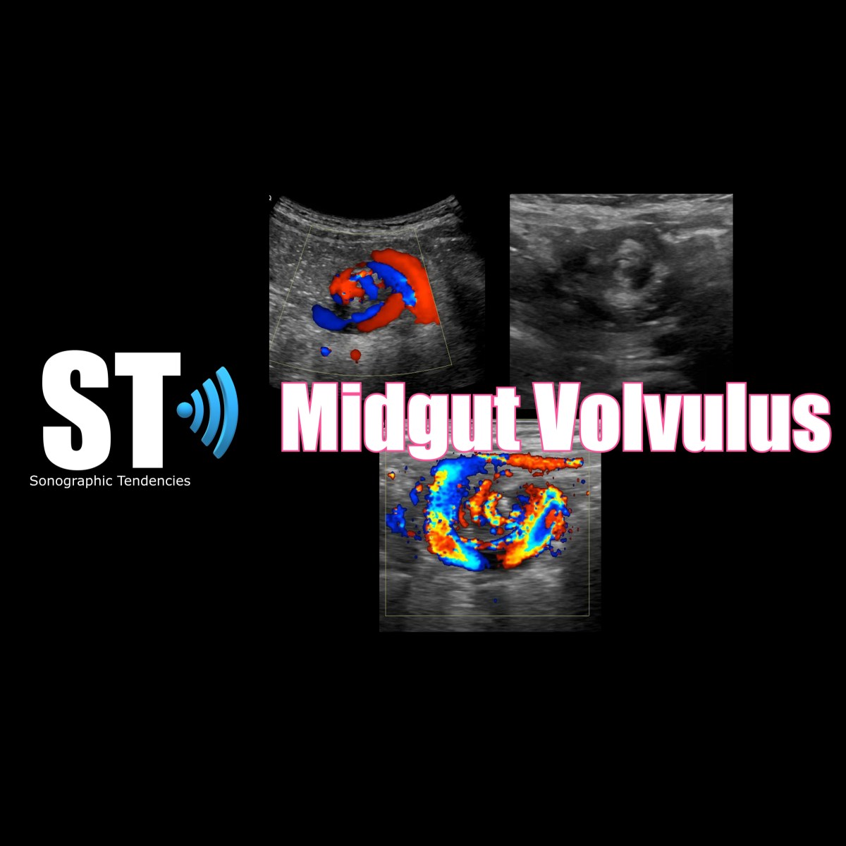 Intestinal Malrotation (Mid Gut Volvulus) – Sonographic Tendencies