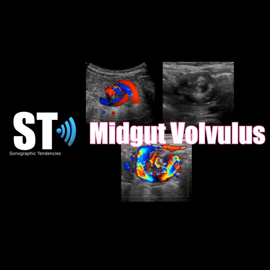 Intestinal Malrotation (Mid Gut Volvulus) – Sonographic Tendencies