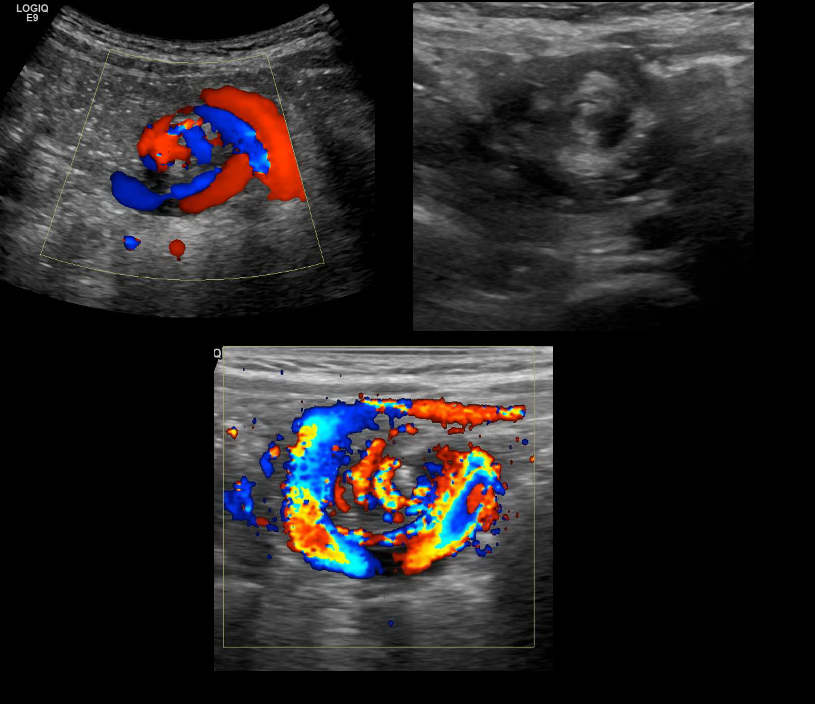 Intestinal Malrotation (Mid Gut Volvulus) – Sonographic Tendencies