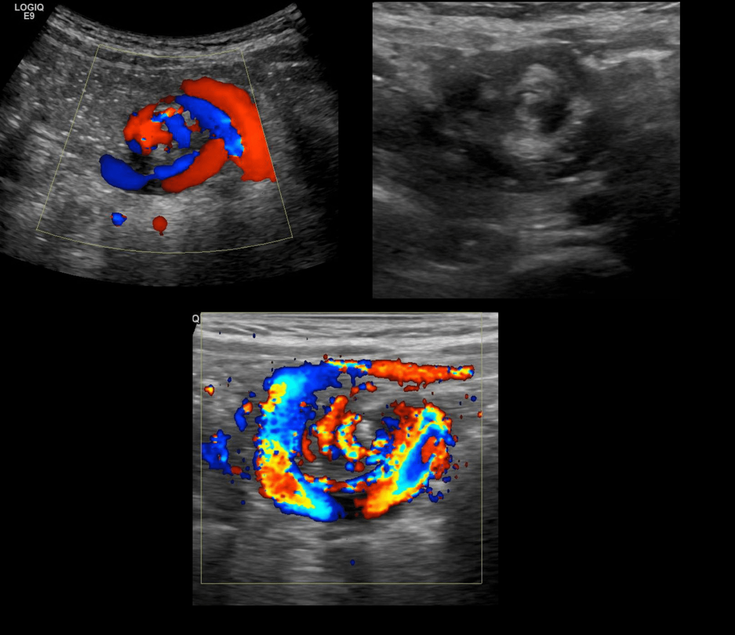 Intestinal Malrotation (Mid Gut Volvulus) – Sonographic Tendencies