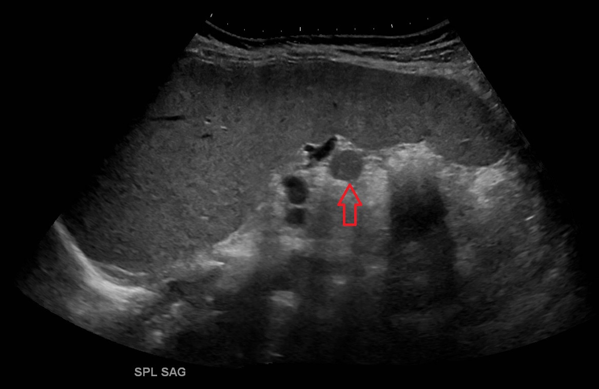 Accessory Spleen (Splenule, Splenunculus) – Sonographic Tendencies