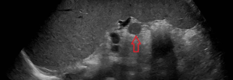 Accessory Spleen (Splenule, Splenunculus) – Sonographic Tendencies