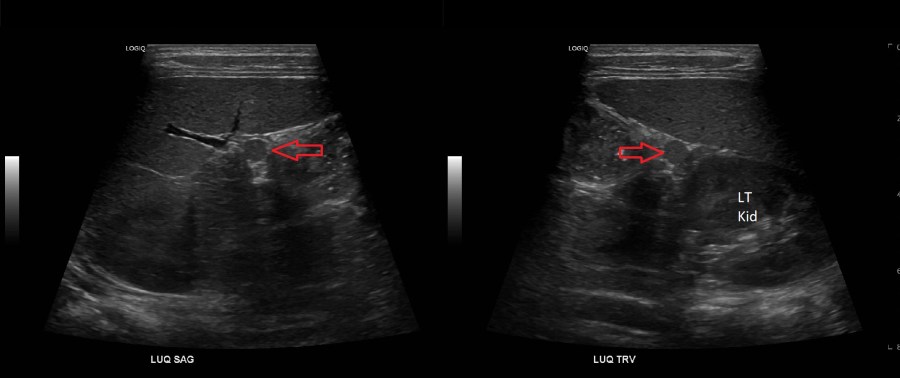 Accessory Spleen (Splenule, Splenunculus) – Sonographic Tendencies