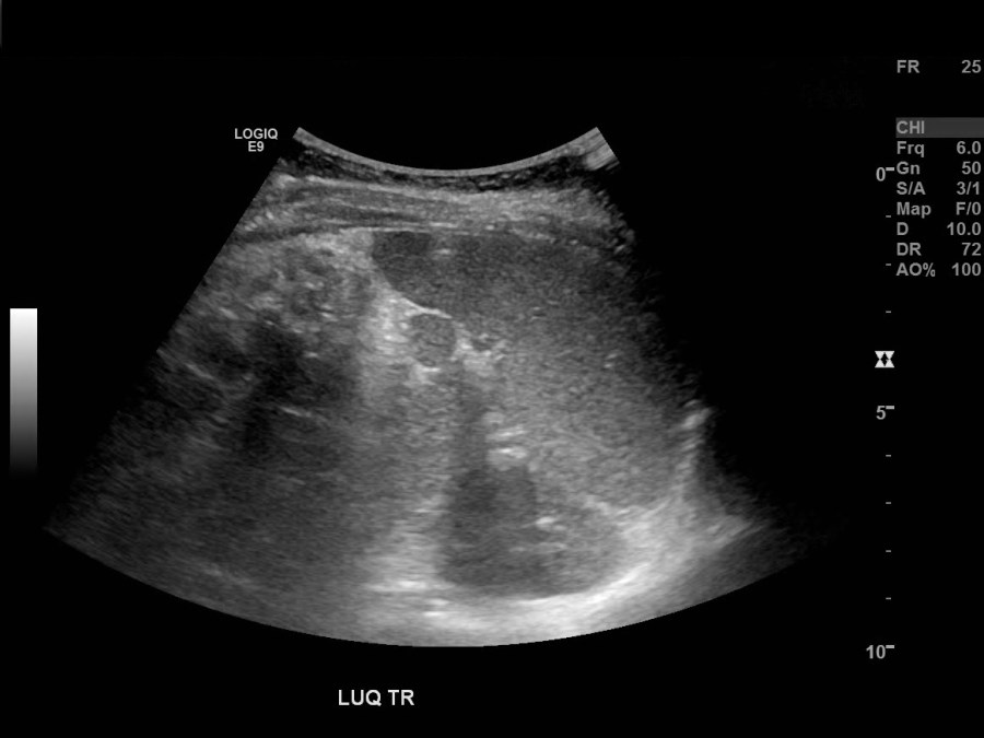 Accessory Spleen (Splenule, Splenunculus) – Sonographic Tendencies
