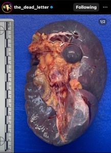 Accessory Spleen (Splenule, Splenunculus) – Sonographic Tendencies